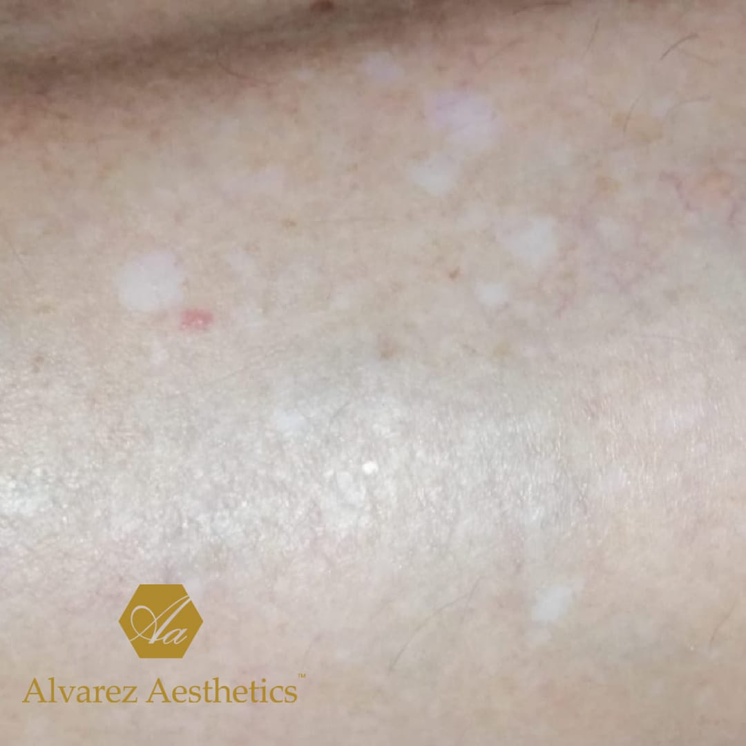 Types of pigmentation - Alvarez Aesthetics